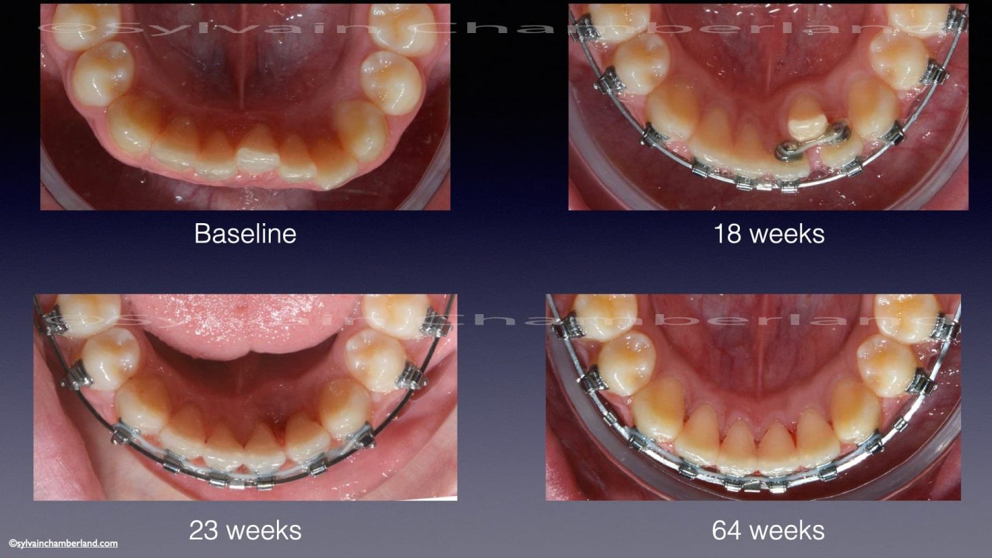 Extraction of a mandibular incisor - Dr. Sylvain Chamberland, Orthodontist