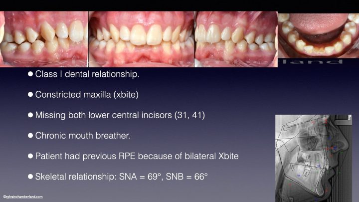 Extraction of a mandibular incisor - Dr. Sylvain Chamberland, Orthodontist