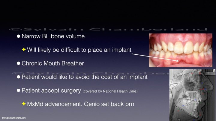 Extraction of a mandibular incisor - Dr. Sylvain Chamberland, Orthodontist