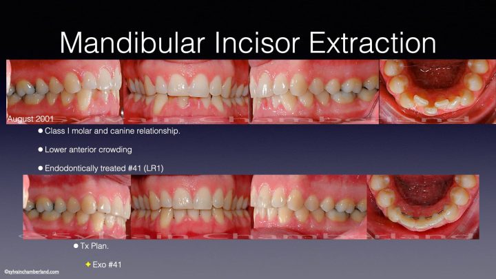 Extraction of a mandibular incisor - Dr. Sylvain Chamberland, Orthodontist
