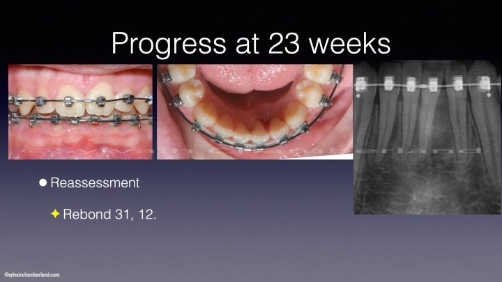 Extraction of a mandibular incisor - Dr. Sylvain Chamberland, Orthodontist