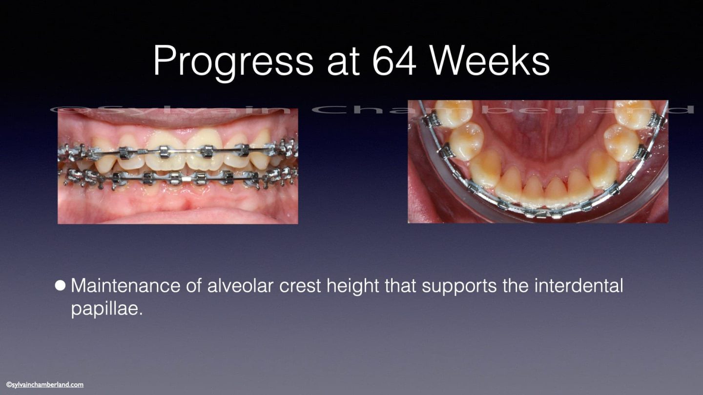 Extraction of a mandibular incisor - Dr. Sylvain Chamberland, Orthodontist
