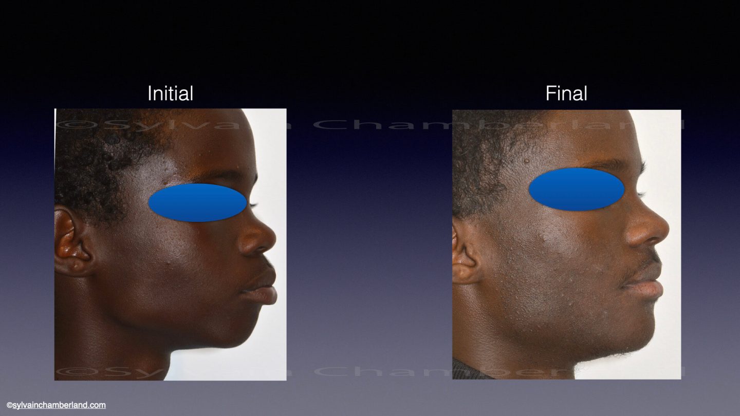 Bimaxillary protrusion / facial harmony - Dr. Sylvain Chamberland ...