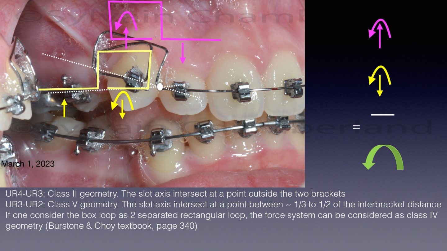 Stoner Box Loop - Dr. Sylvain Chamberland, Orthodontist