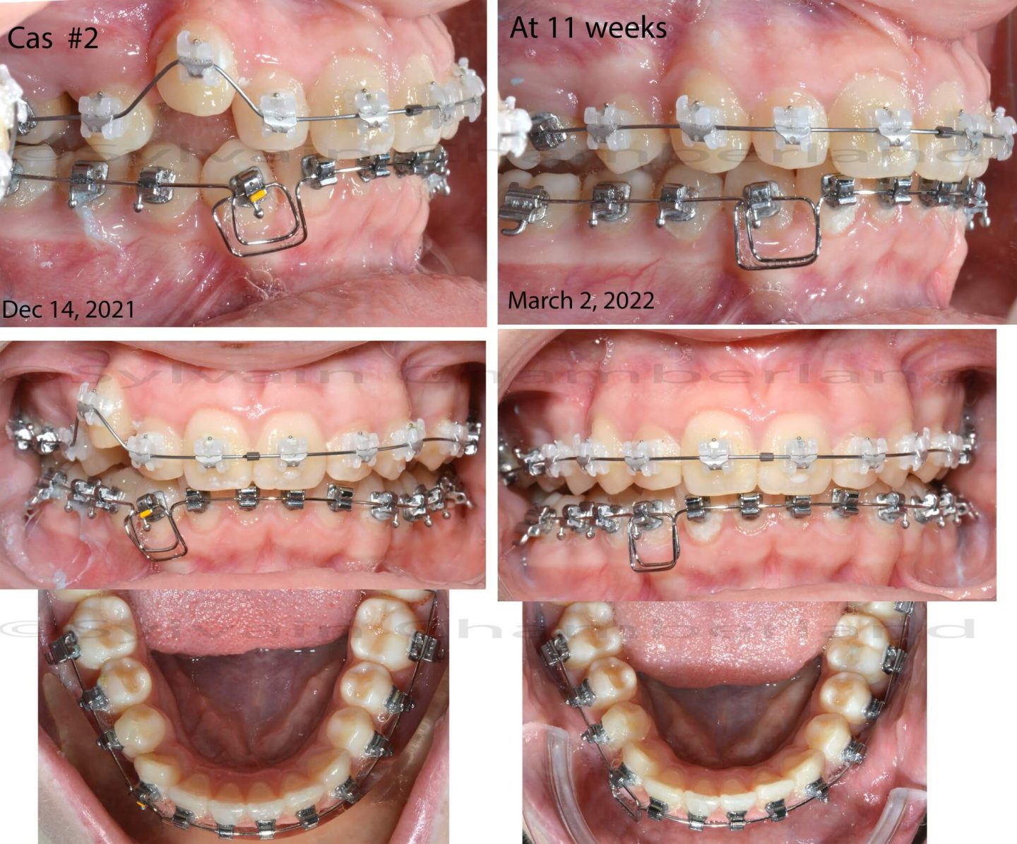 Stoner Box Loop - Dr. Sylvain Chamberland, Orthodontist