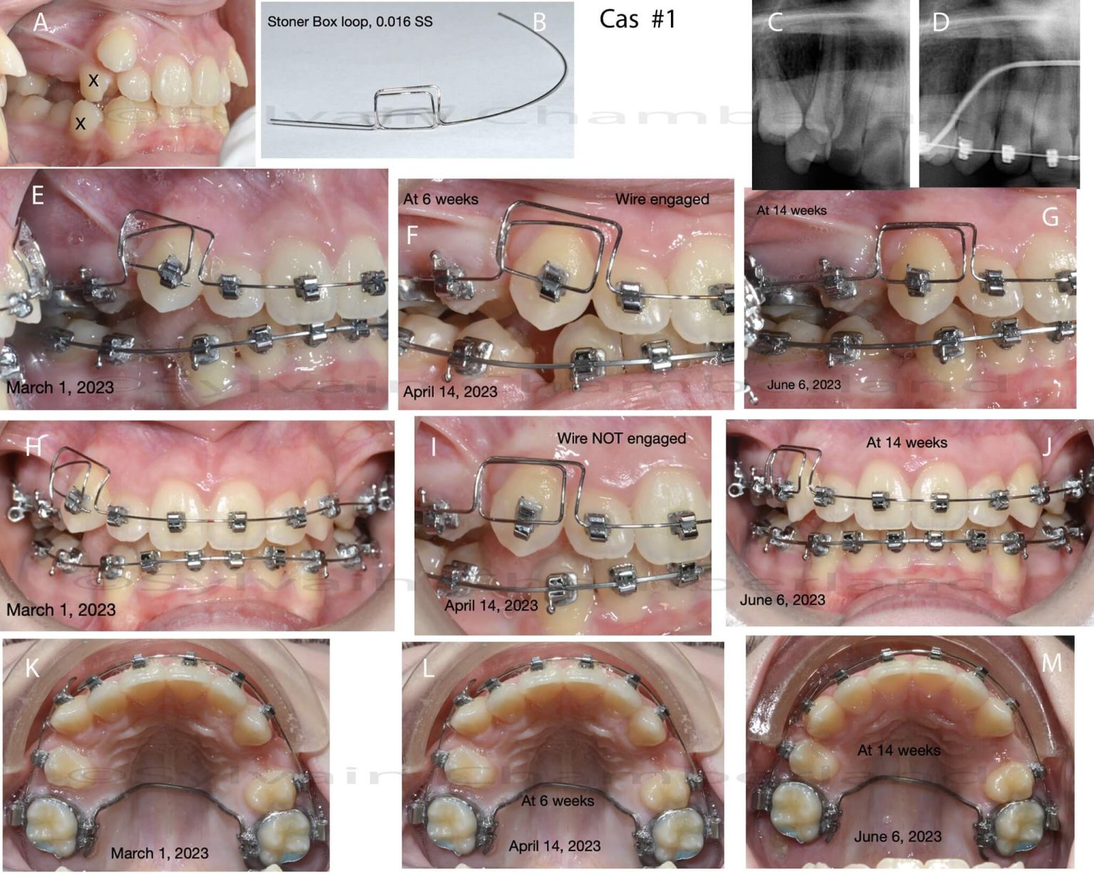 Stoner Box Loop - Dr Sylvain Chamberland, Orthodontiste