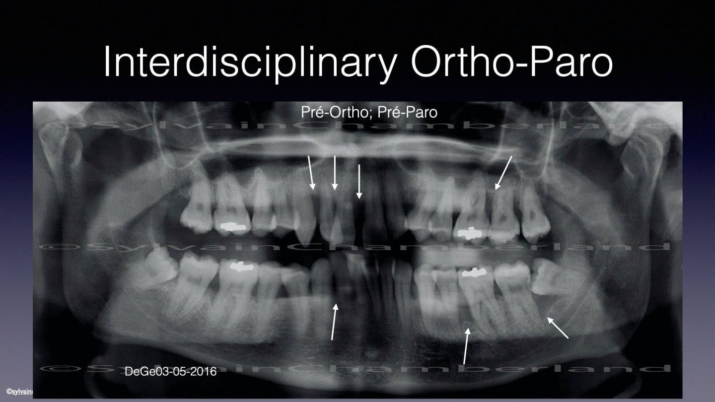 Interdisciplinary treatment Ortho-Perio - Dr. Sylvain Chamberland ...