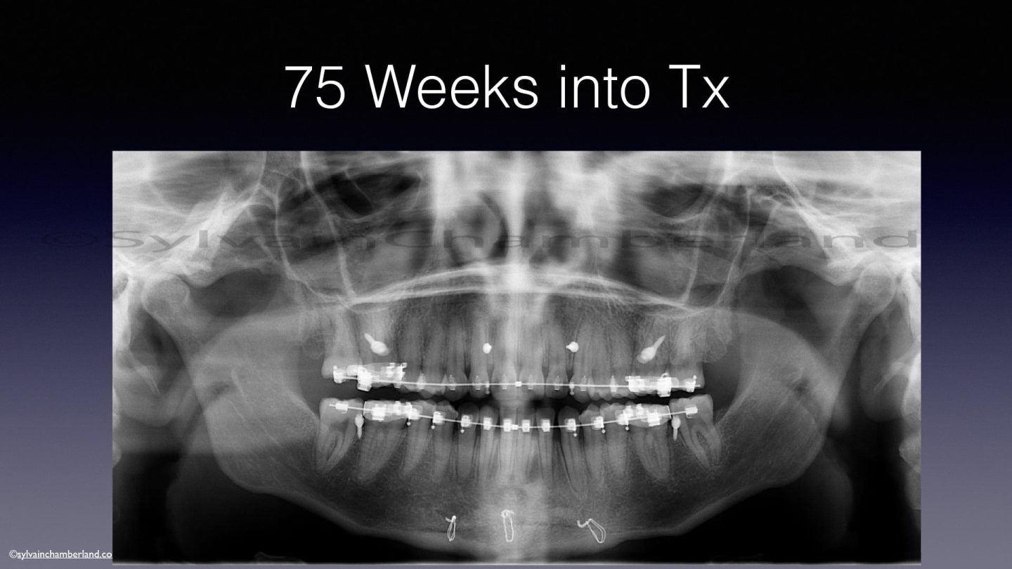 Non-surgical treatment of anterior open bite - Dr. Sylvain Chamberland ...