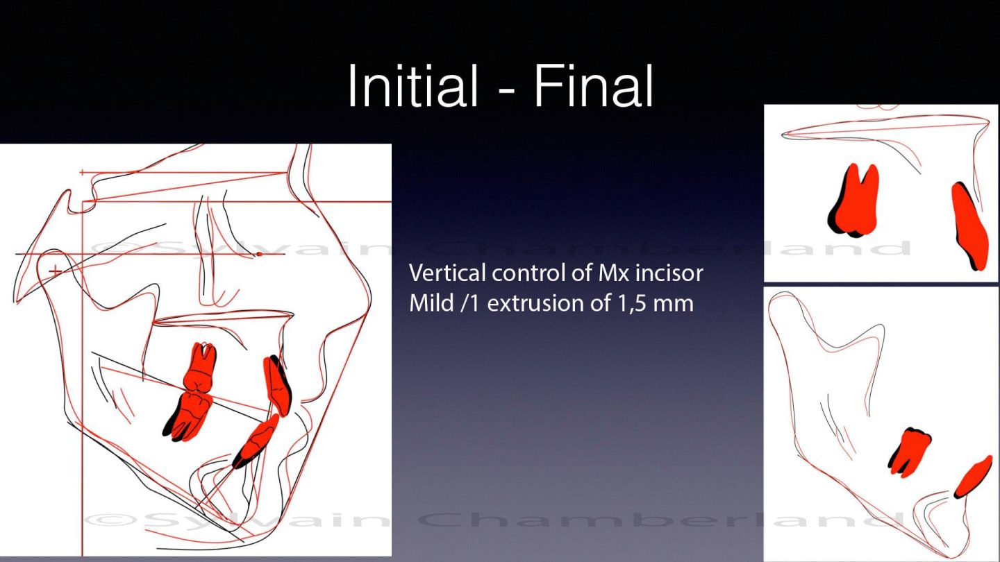 Non-surgical treatment of anterior open bite - Dr. Sylvain Chamberland ...