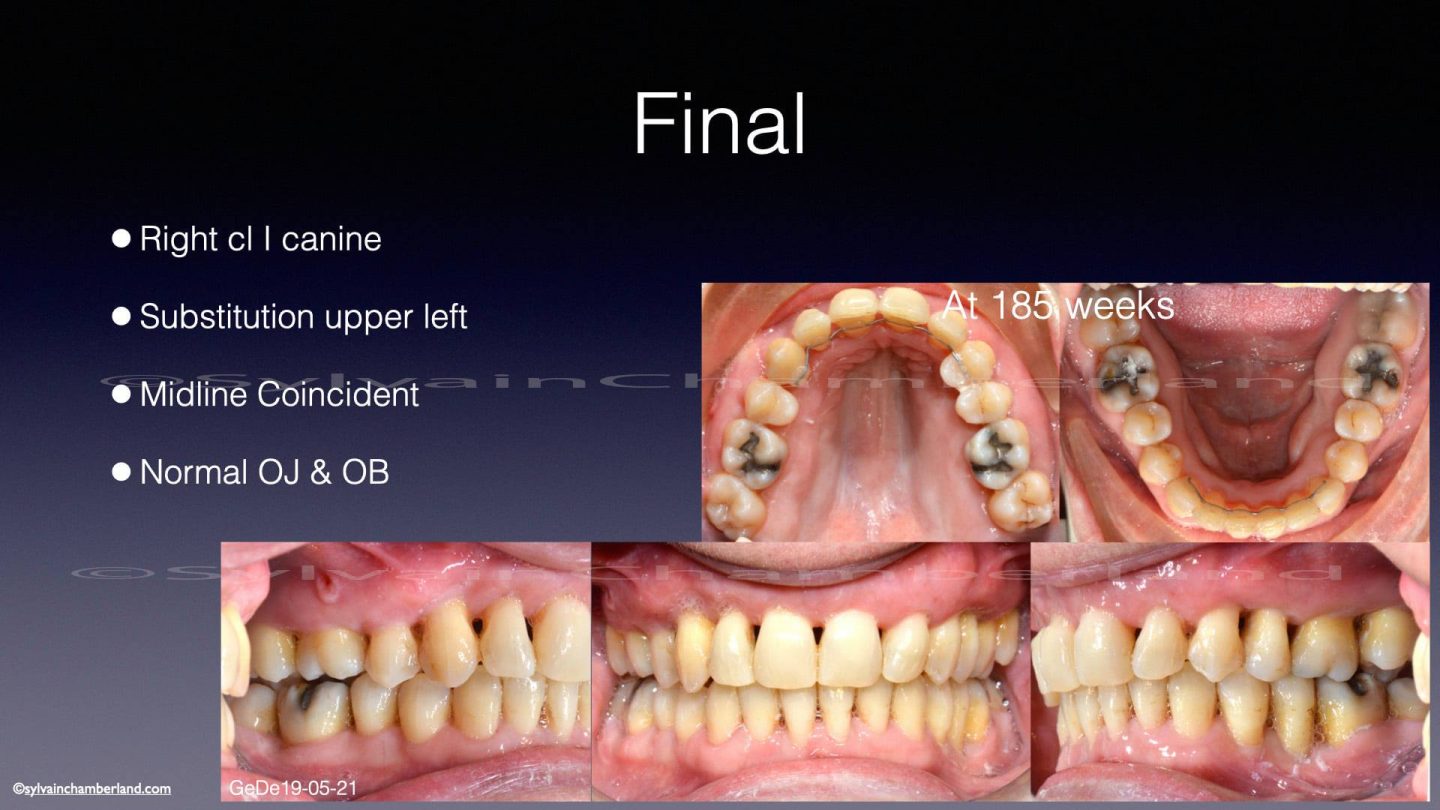 Interdisciplinary treatment Ortho-Perio - Dr. Sylvain Chamberland ...