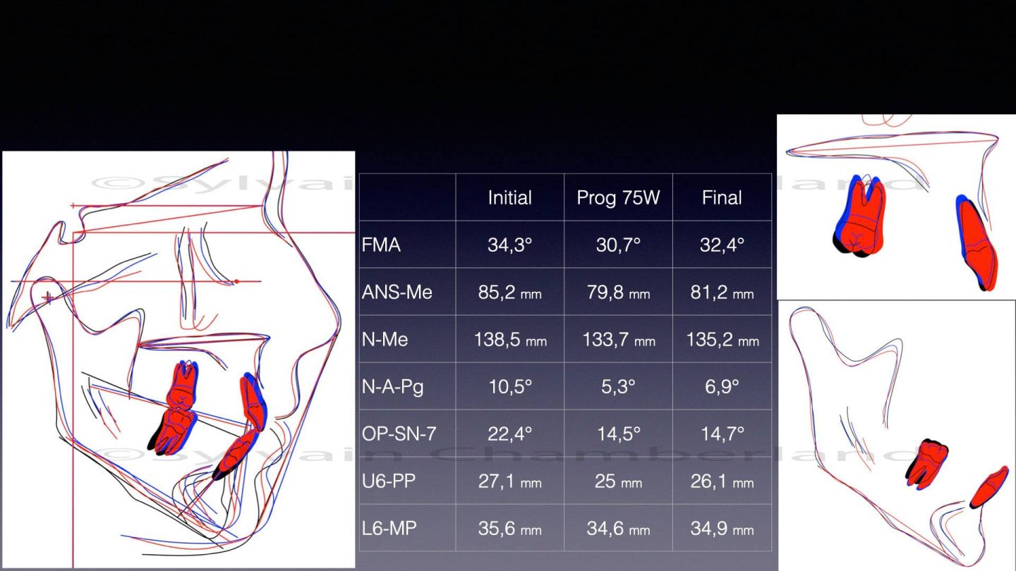 Non-surgical treatment of anterior open bite - Dr. Sylvain Chamberland ...
