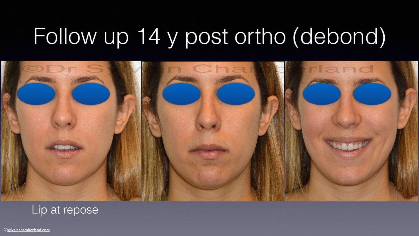 Non-surgical treatment of anterior open bite - Dr. Sylvain Chamberland ...