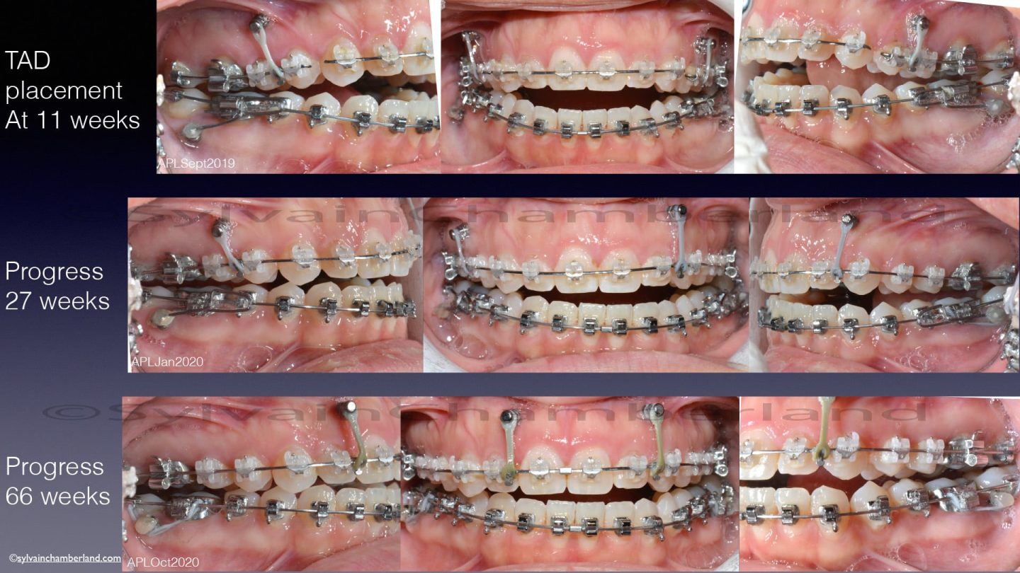 Non-surgical treatment of anterior open bite - Dr. Sylvain Chamberland ...