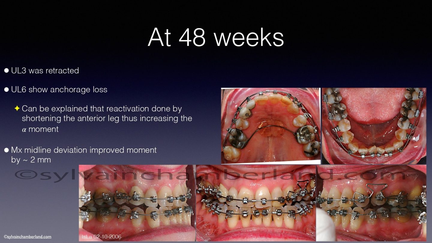 Adult, cl III. Absence of lateral incisor - Dr. Sylvain Chamberland ...