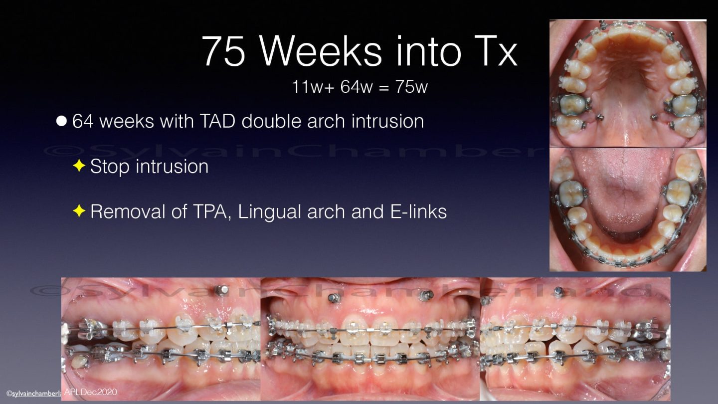 Non-surgical treatment of anterior open bite - Dr. Sylvain Chamberland ...