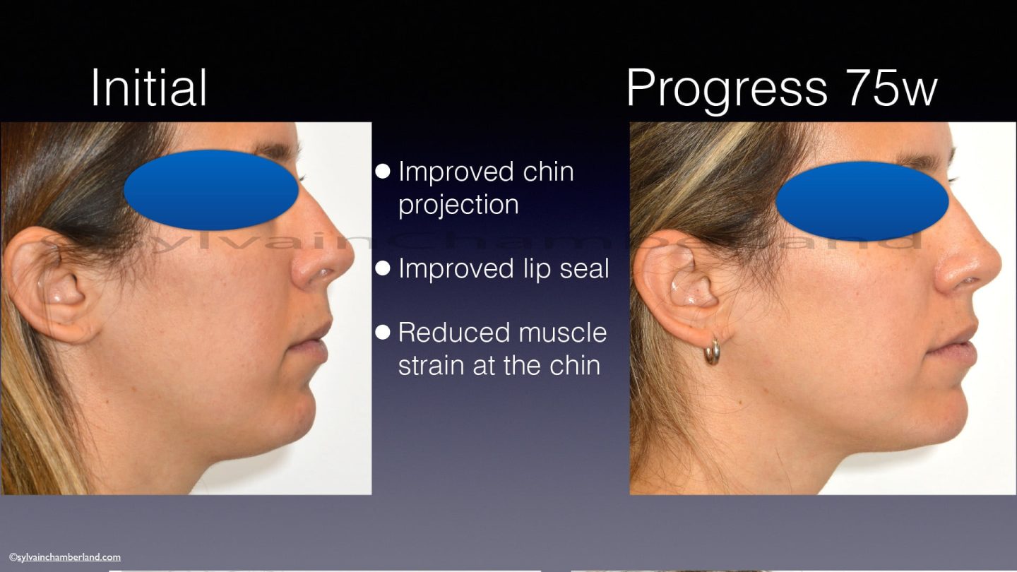 Non-surgical treatment of anterior open bite - Dr. Sylvain Chamberland ...