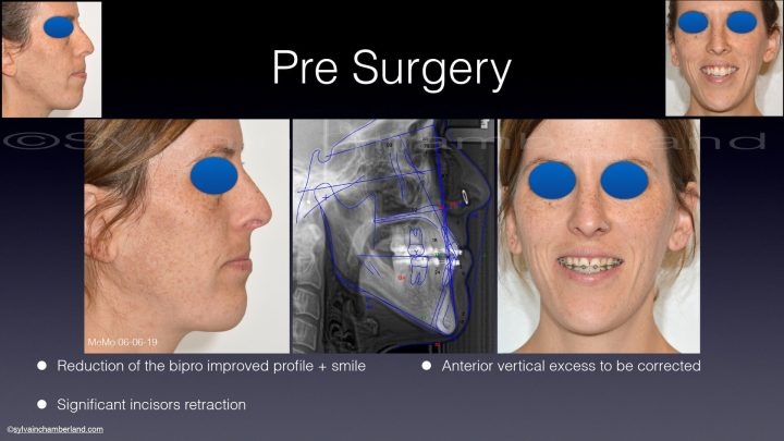 Vertical dimension and facial aesthetics - Dr. Sylvain Chamberland ...