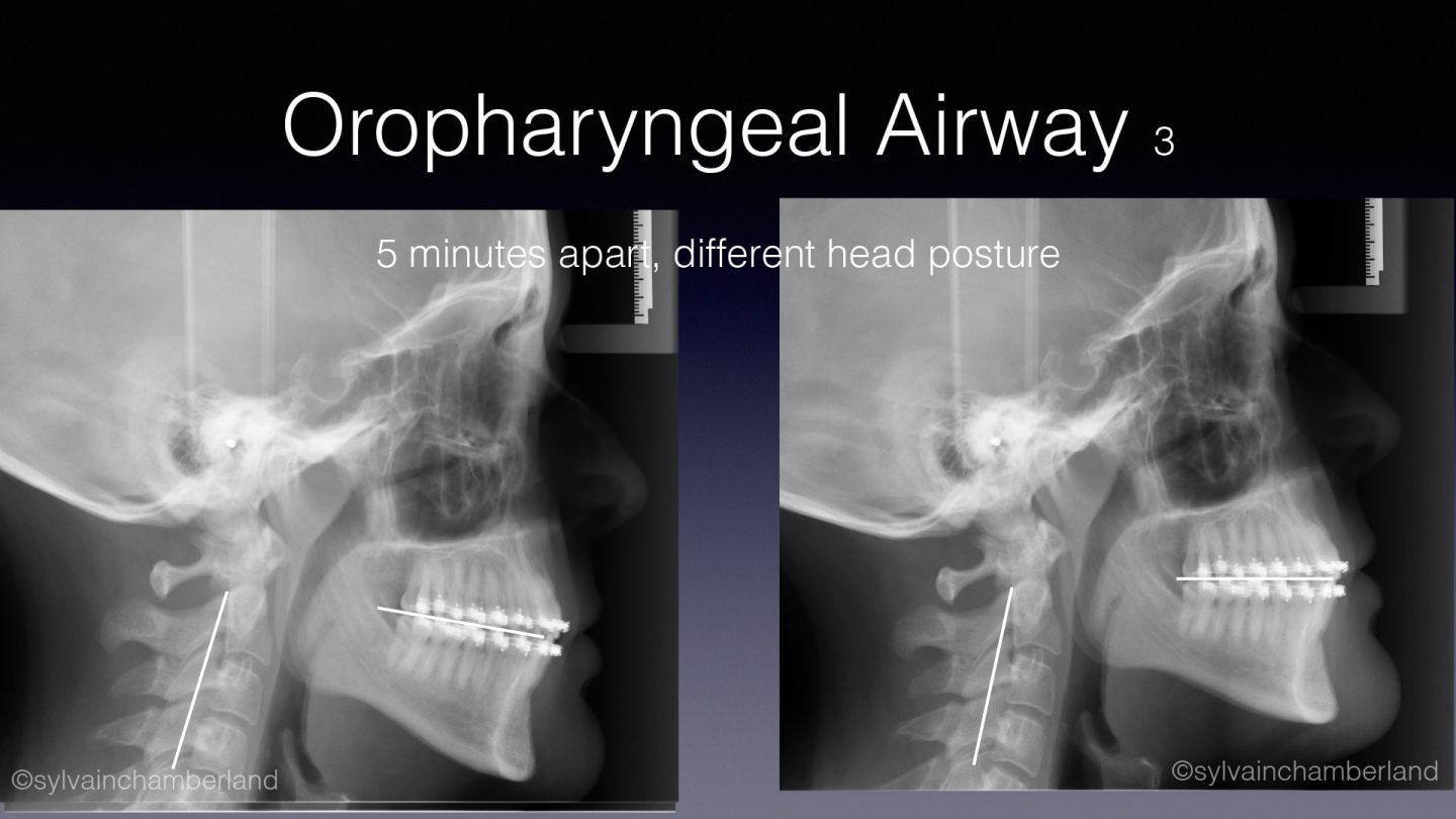 Évaluation des voies aériennes sur une radiographie céphalométrique ...
