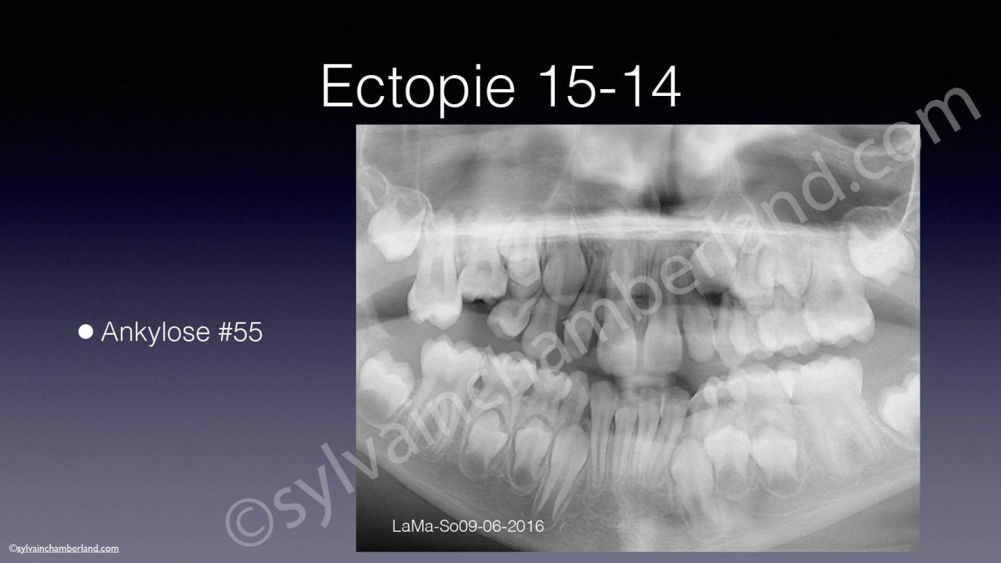Ankylosis and #55 inclusion - Dr. Sylvain Chamberland, Orthodontist