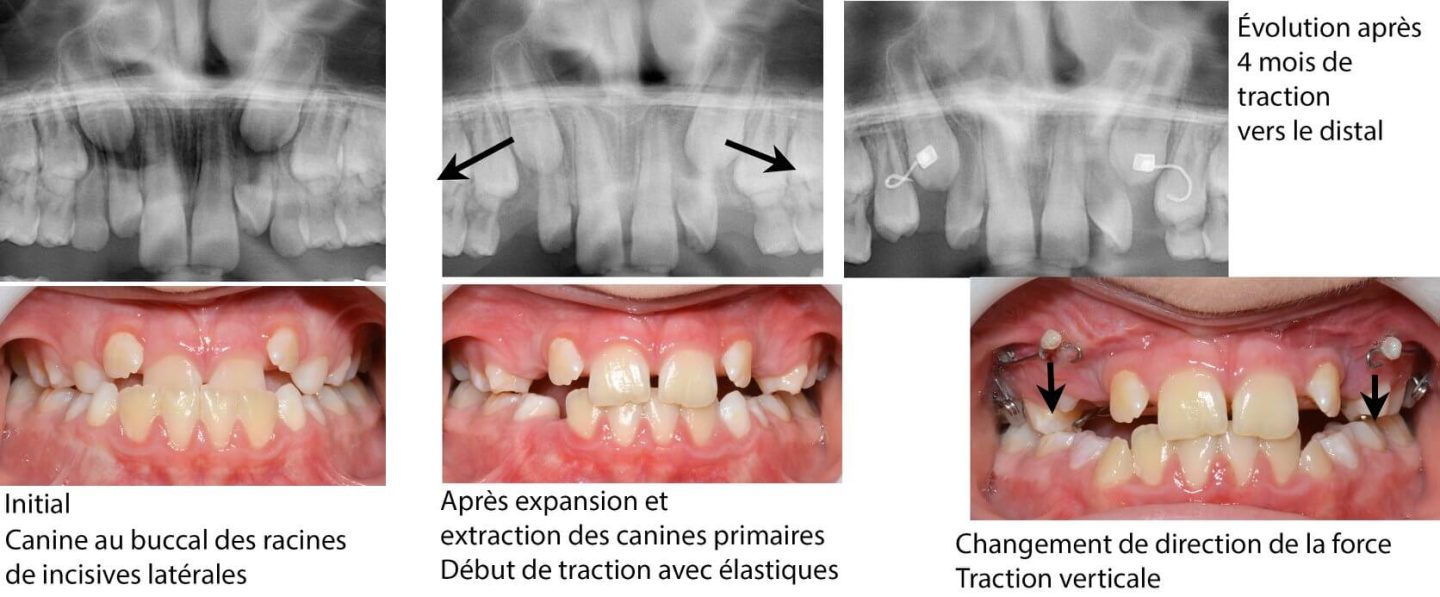 Canine included in vestibular position - Dr. Sylvain Chamberland ...