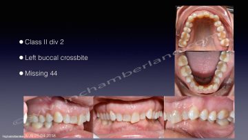Symphyseal mandibular distraction - Dr. Sylvain Chamberland, Orthodontist