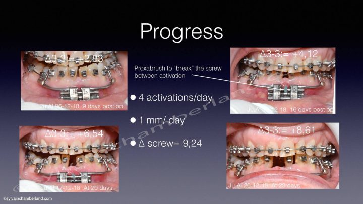 Symphyseal mandibular distraction - Dr. Sylvain Chamberland, Orthodontist