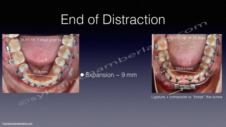 Symphyseal mandibular distraction - Dr. Sylvain Chamberland, Orthodontist