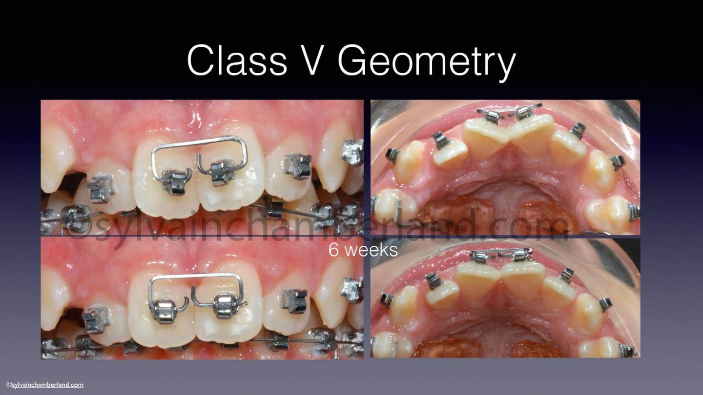 Creative wire bending - Dr. Sylvain Chamberland, Orthodontist
