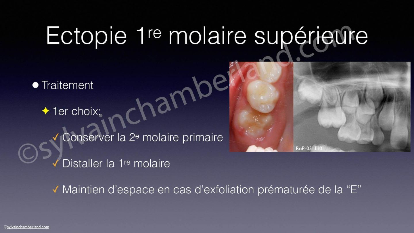 Impaction 1re molaire supérieure - Dr Sylvain Chamberland, Orthodontiste