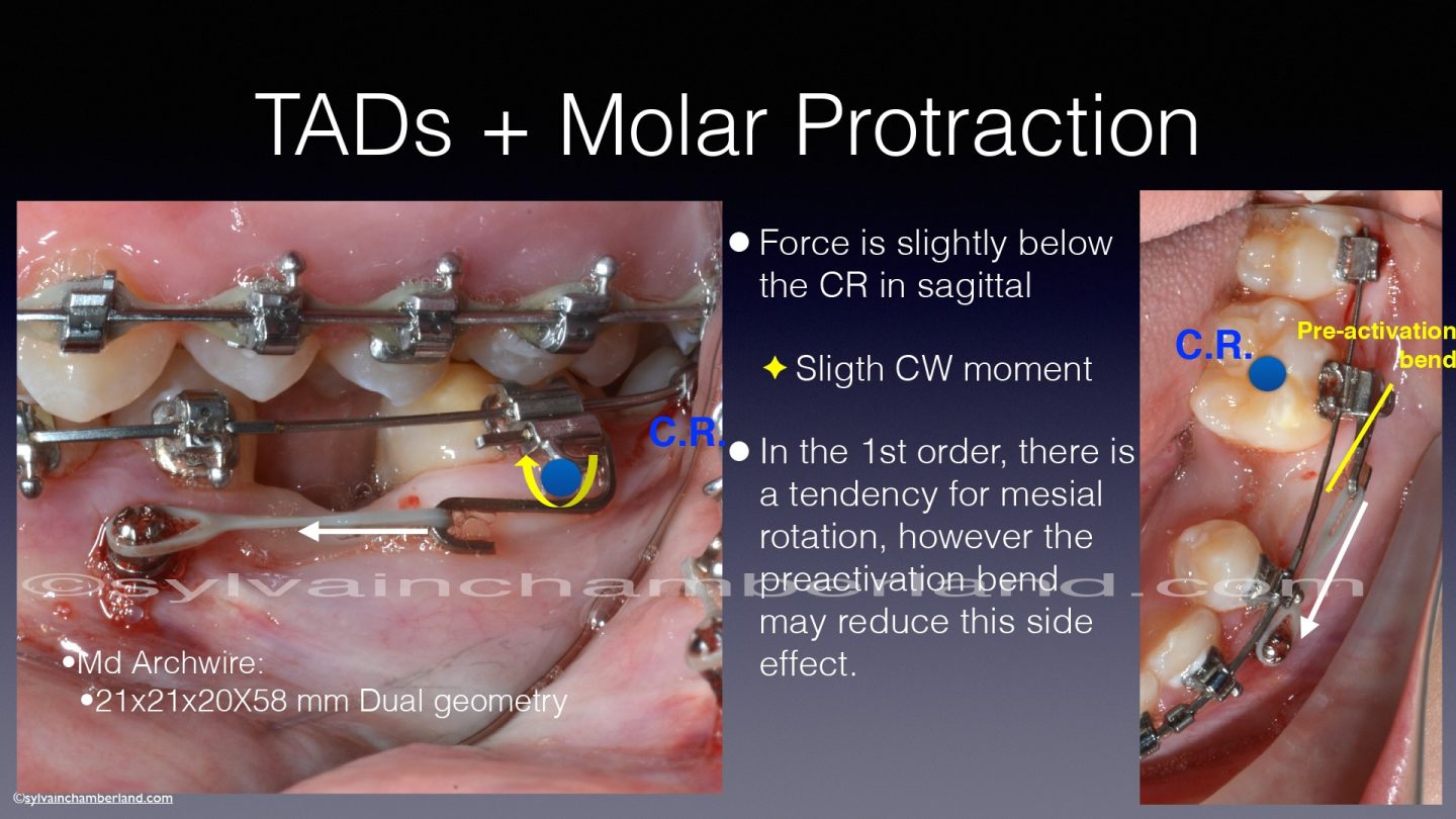 Minivis d'ancrage et protraction molaire - Dr. Sylvain Chamberland ...