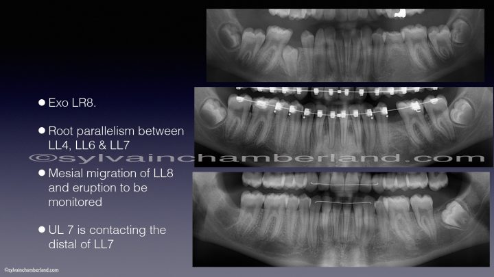 Minivis anchorage and molar protraction - Dr. Sylvain Chamberland ...