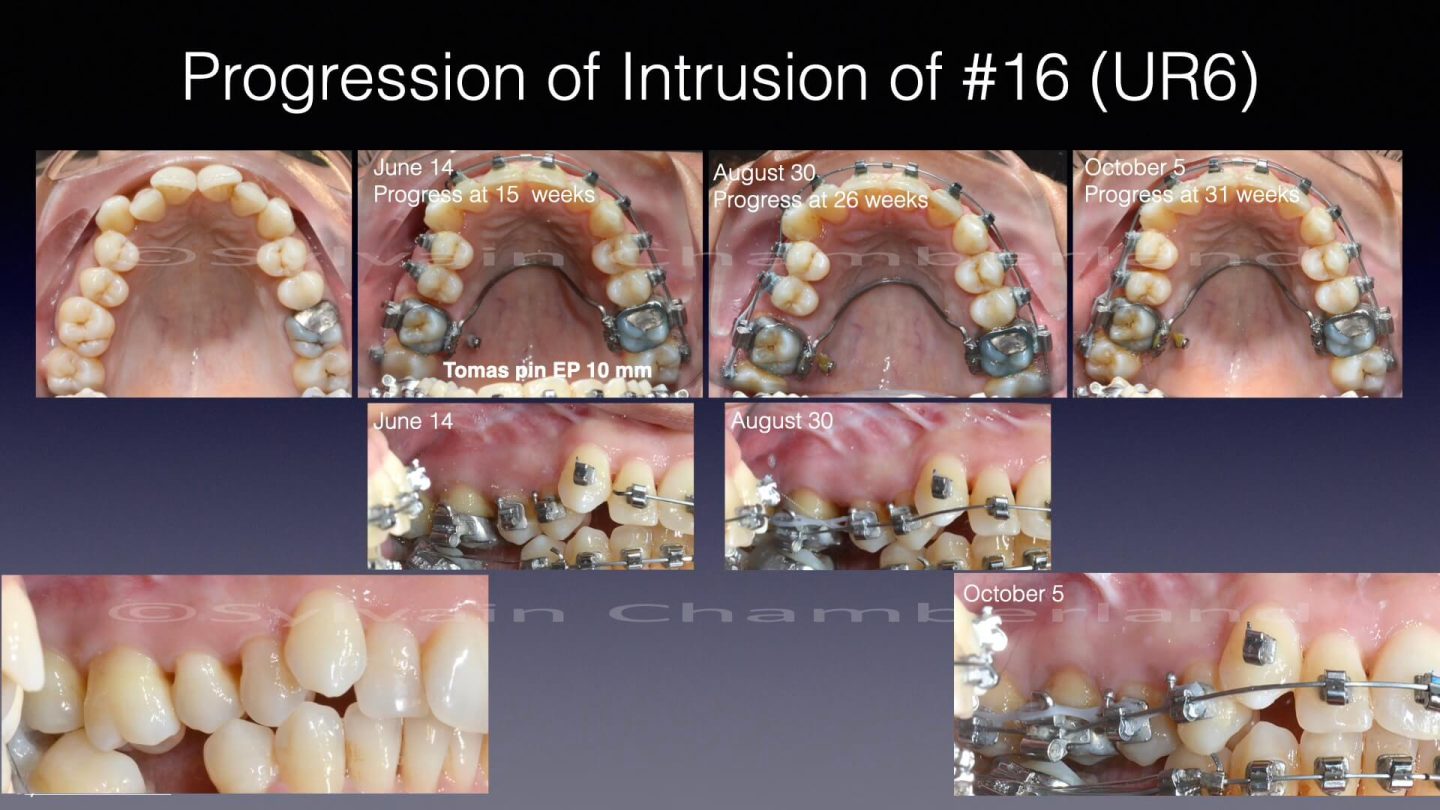 Ressort radiculaire et arc lingual - Dr Sylvain Chamberland, Orthodontiste