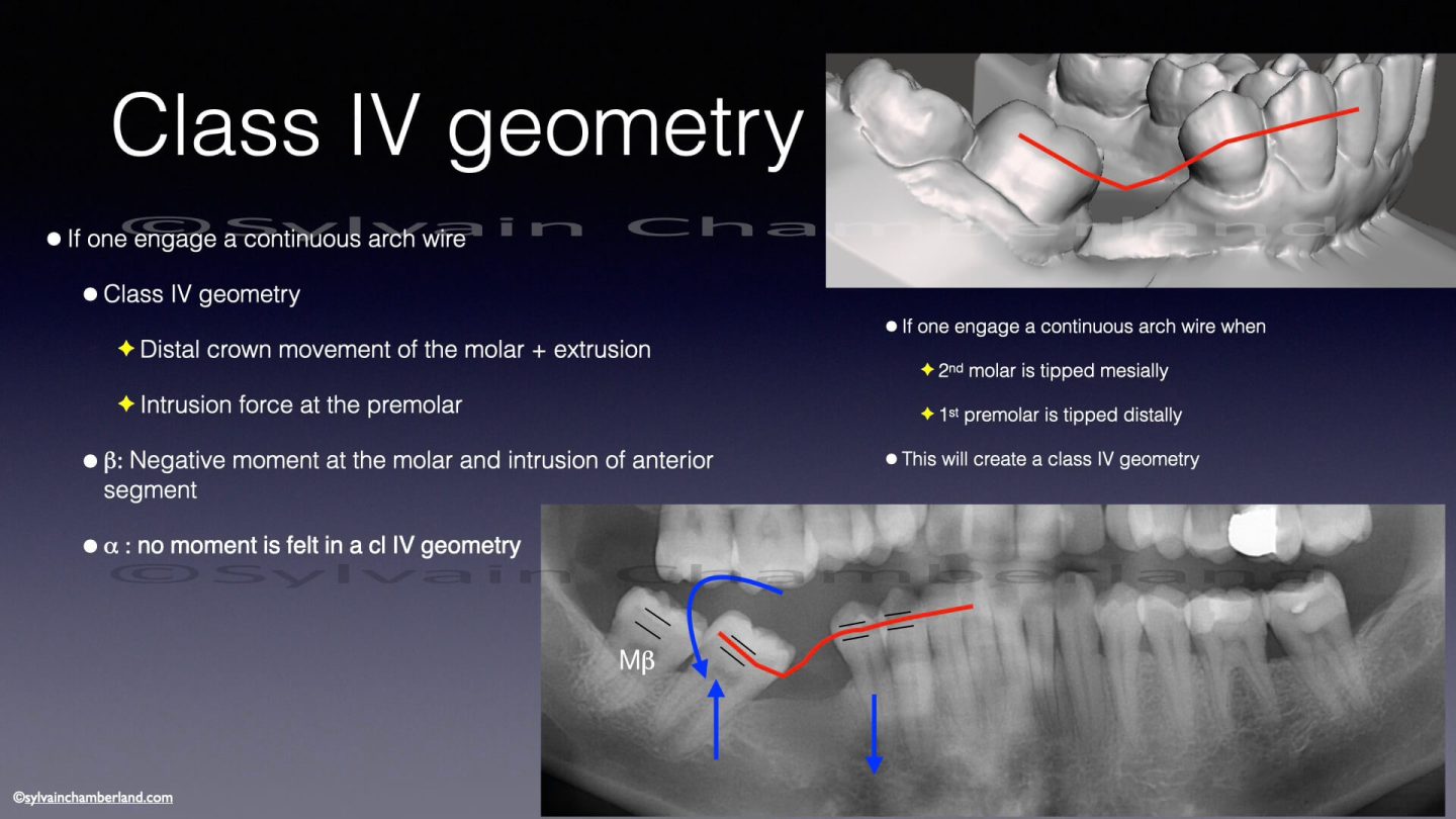 Ressort radiculaire et arc lingual - Dr Sylvain Chamberland, Orthodontiste