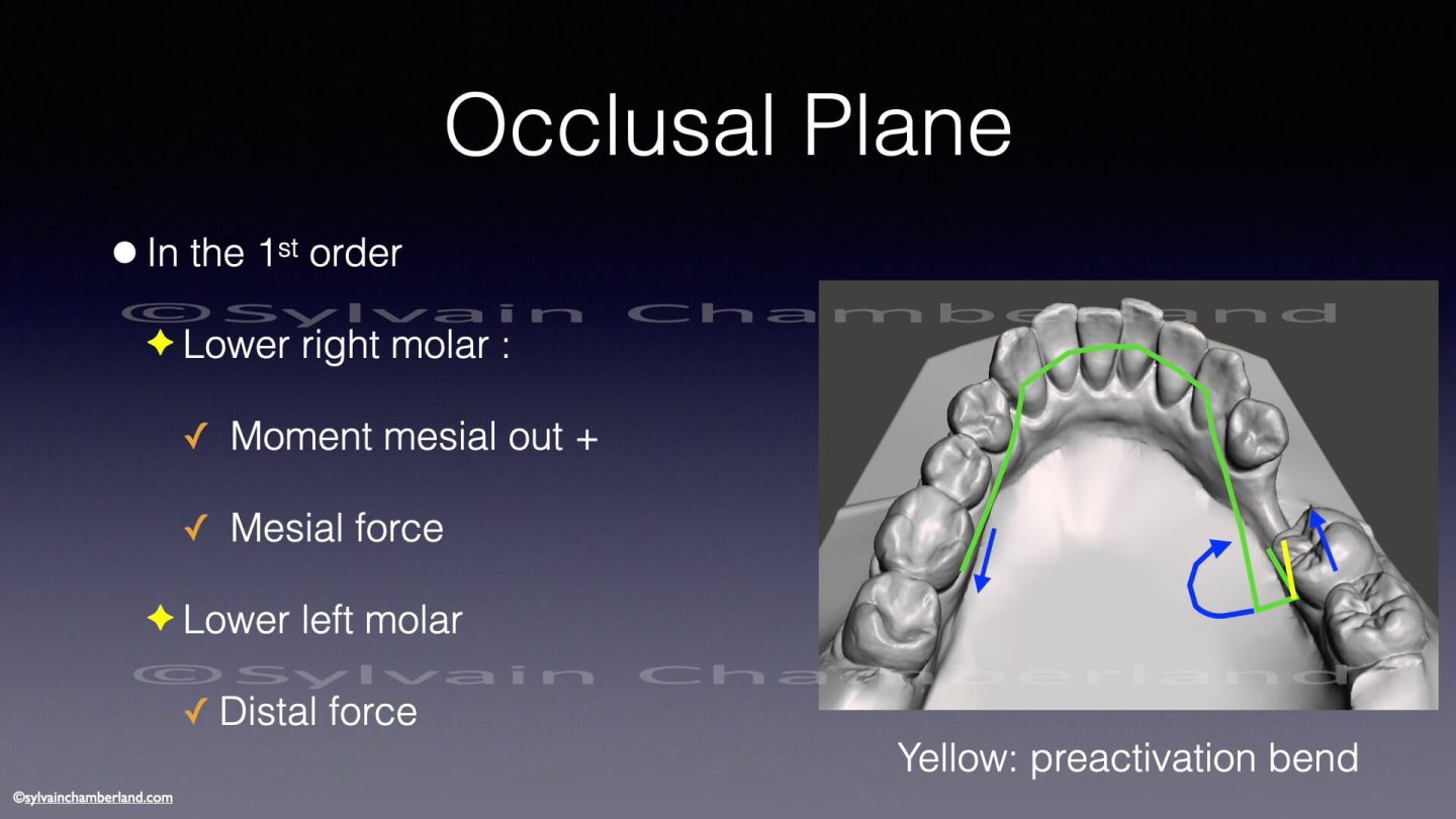 Ressort radiculaire et arc lingual - Dr Sylvain Chamberland, Orthodontiste