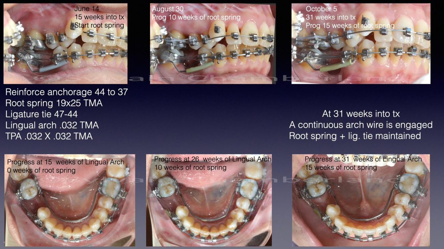 Root Spring and Lingual Arch - Dr. Sylvain Chamberland, Orthodontist