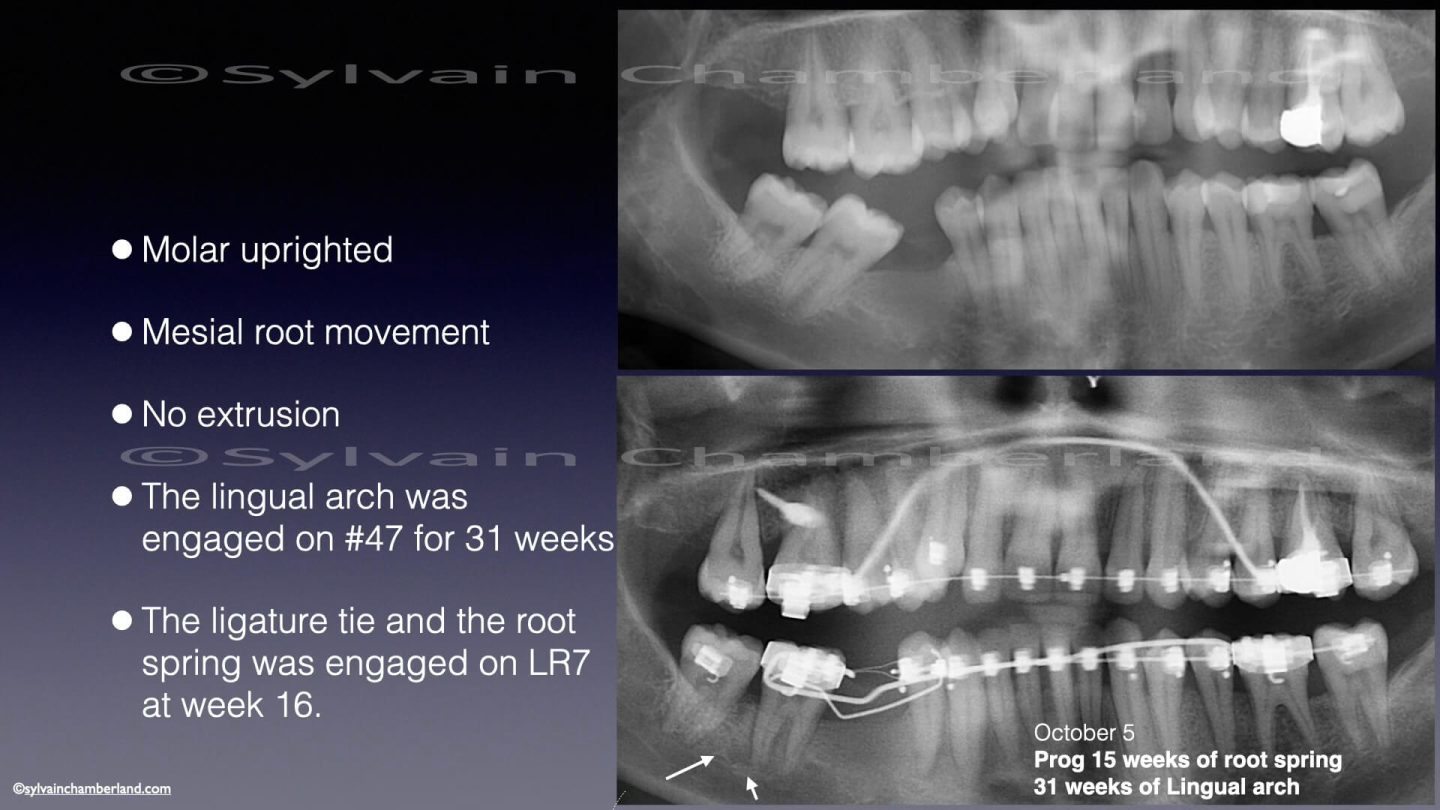 Root Spring and Lingual Arch - Dr. Sylvain Chamberland, Orthodontist