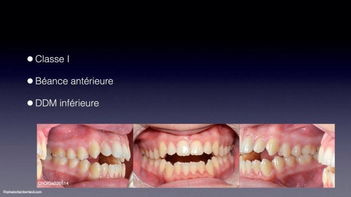 Molar intrusion and minivis - Dr. Sylvain Chamberland, Orthodontist